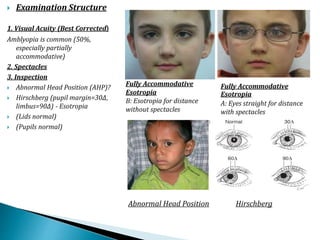 ACCOMMODATIVE ESOTROPIA.pptx............ | PPTX