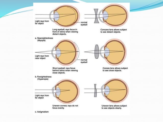 Accomodation reflex | PPTX | Eye and Vision Conditions | Diseases and ...