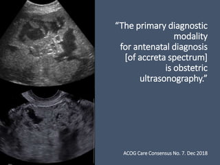 Placenta Accreta Spectrum - The Role for Magnetic Resonance Imaging ...