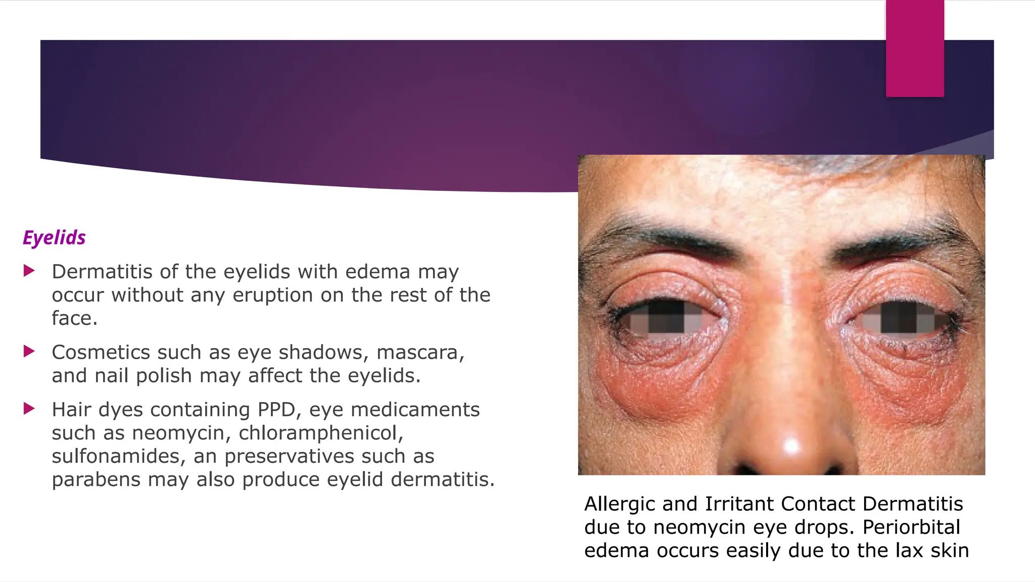 ALLERGIC CONTACT DERMATITIS PRESENTATION , dermatology | PPTX