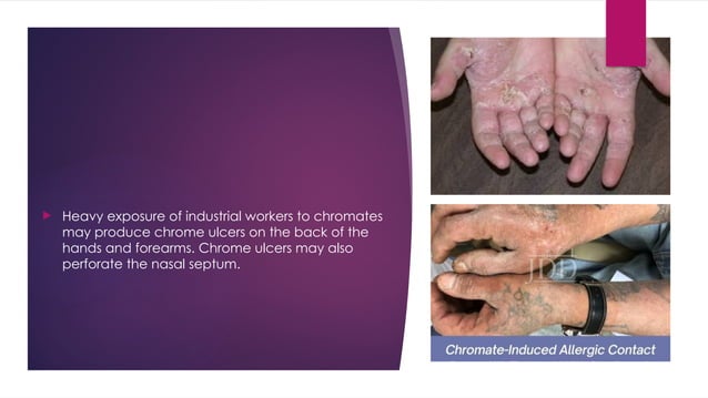 ALLERGIC CONTACT DERMATITIS PRESENTATION , dermatology | PPTX