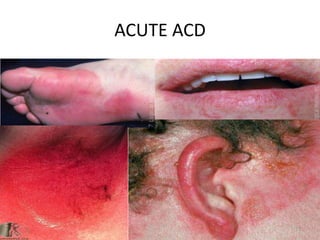 Acd by aseem | PPTX | Allergies | Diseases and Conditions