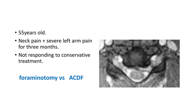 Acdf vs foraminotomy | PPT