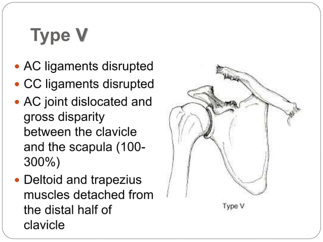 Ac dislocation | PPT