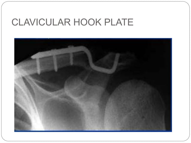 Ac dislocation | PPT