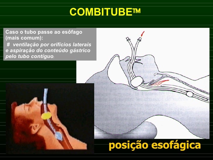 Acesso à Via Aérea Não Invasivo