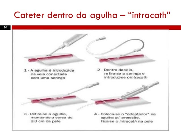 Acesso venoso central