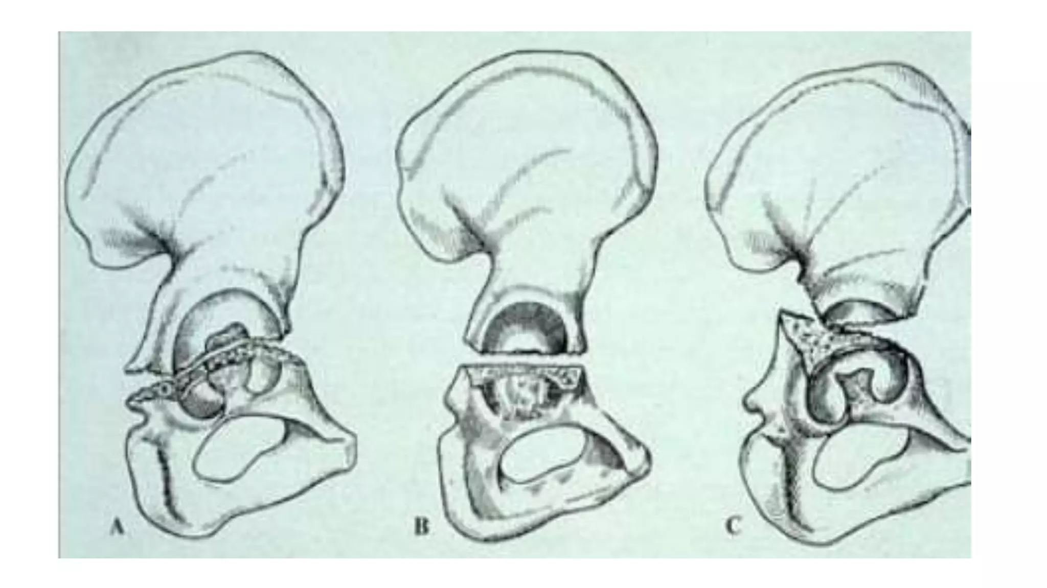 Acetabular fractures | PPTX