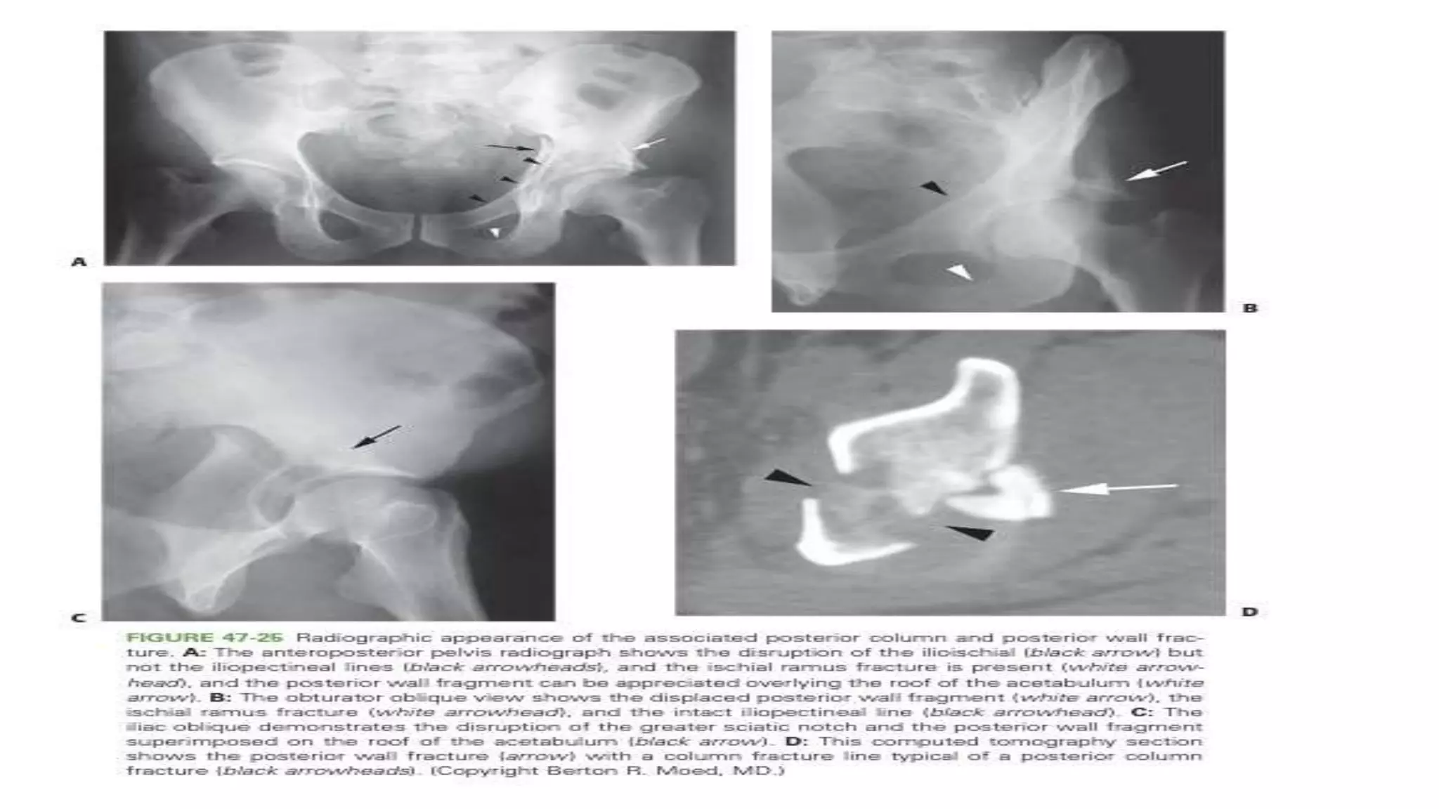 Acetabular fractures | PPT