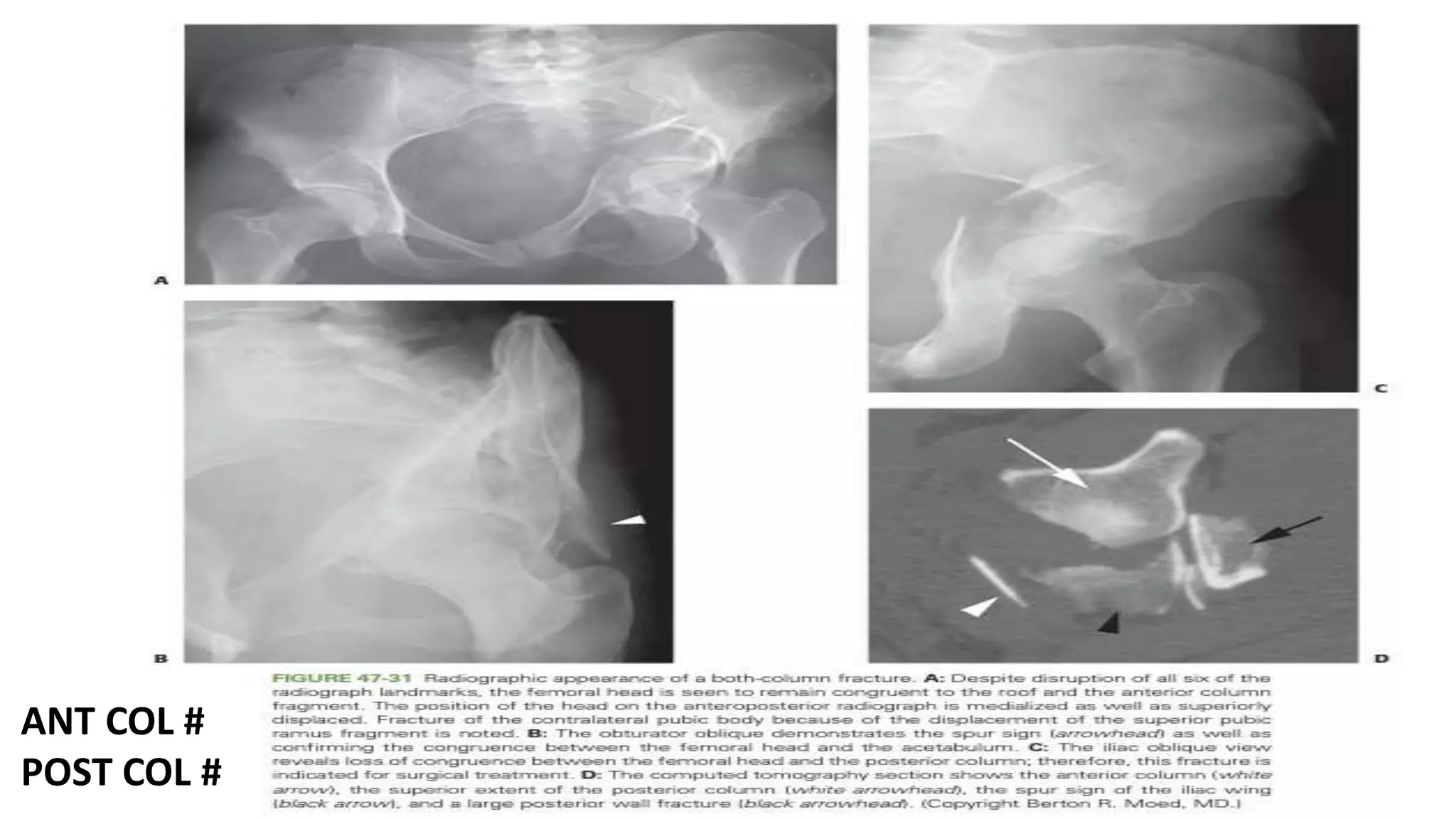 Acetabular fractures | PPT