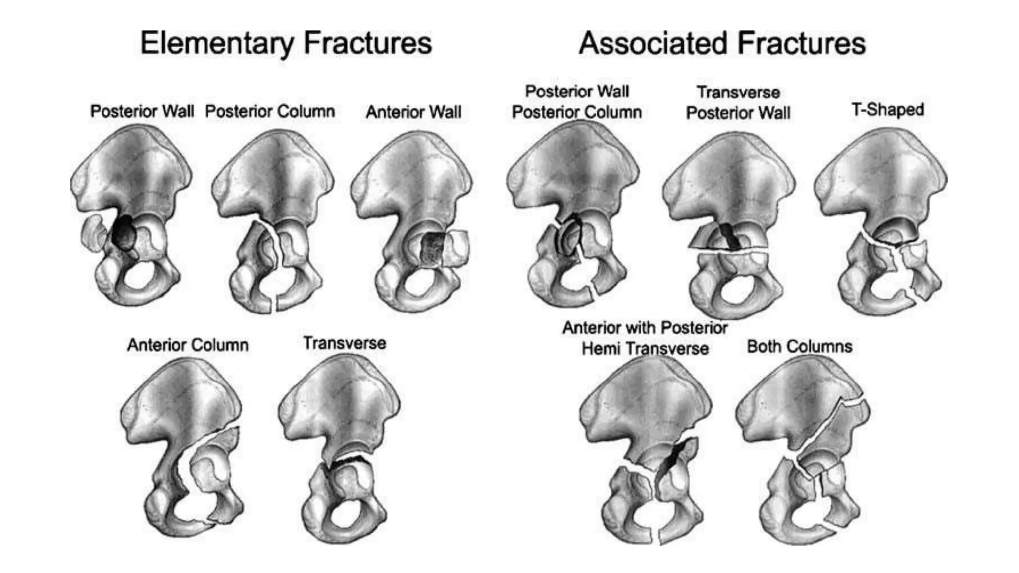 Acetabular fractures | PPT