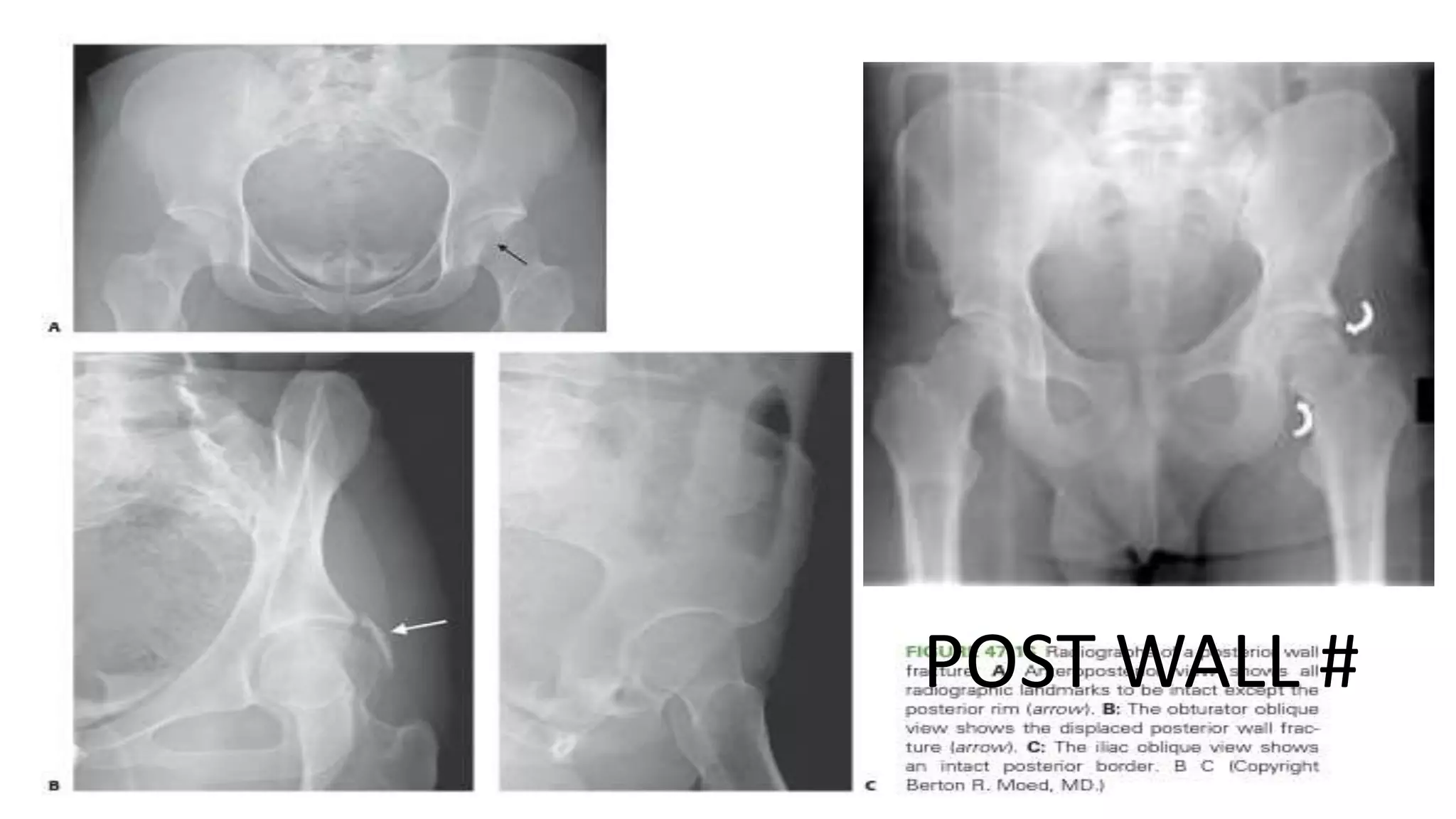 Acetabular fractures | PPTX