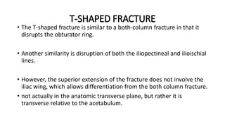 Acetabular fractures | PPT