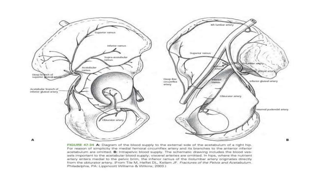 Acetabular fractures | PPT