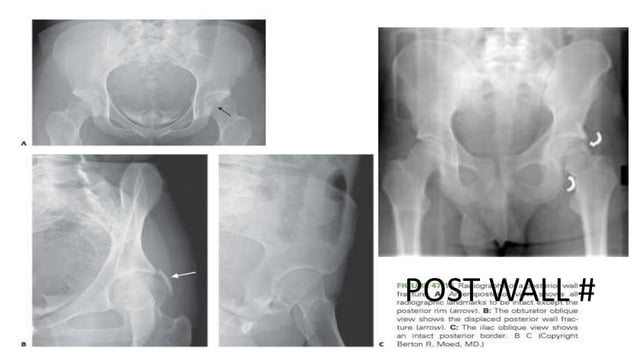 Acetabular fractures | PPT