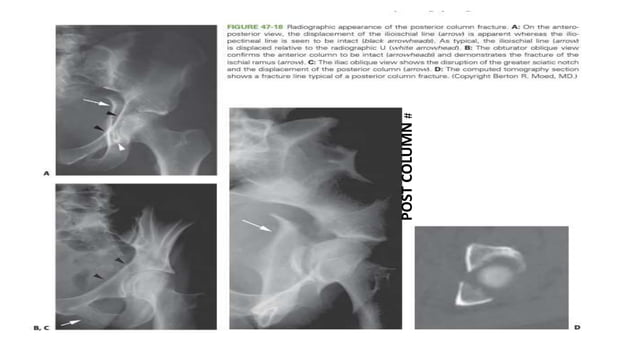 Acetabular fractures | PPT