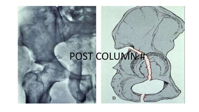 Acetabular fractures | PPT