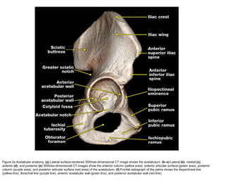 Acetabaular fracture.pptx management and recovery | PPTX