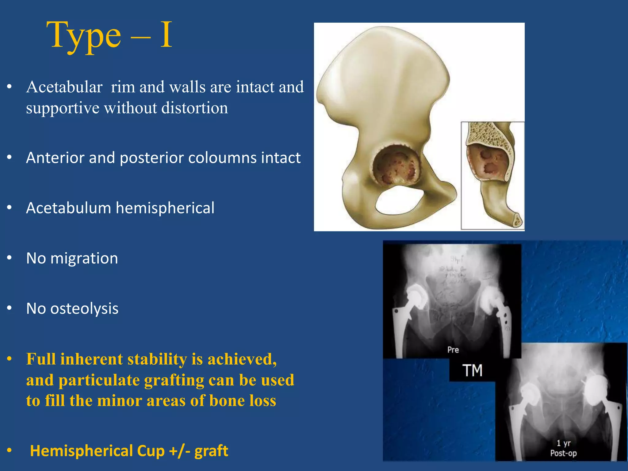 Acetabular defects | PPTX