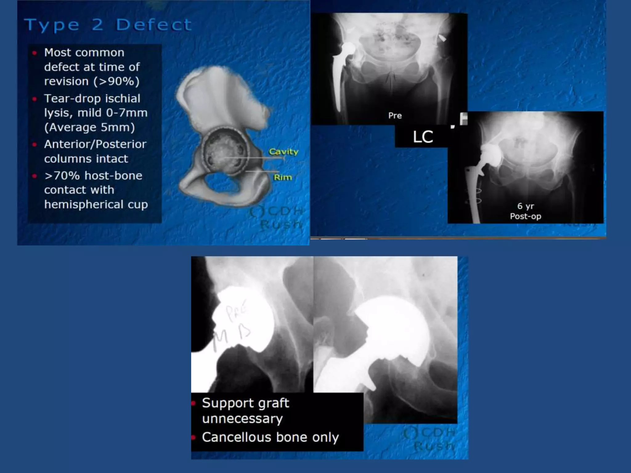Acetabular defects | PPTX