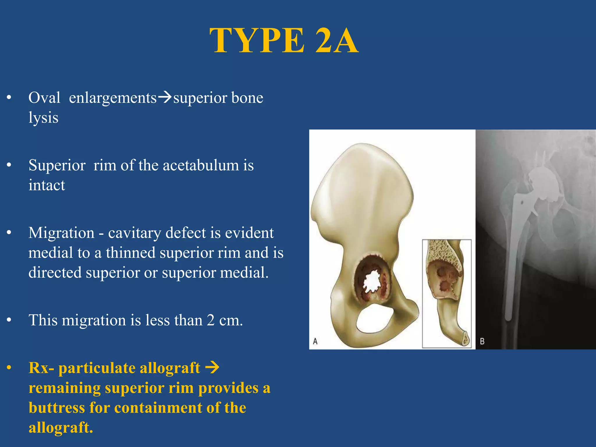 Acetabular defects | PPTX