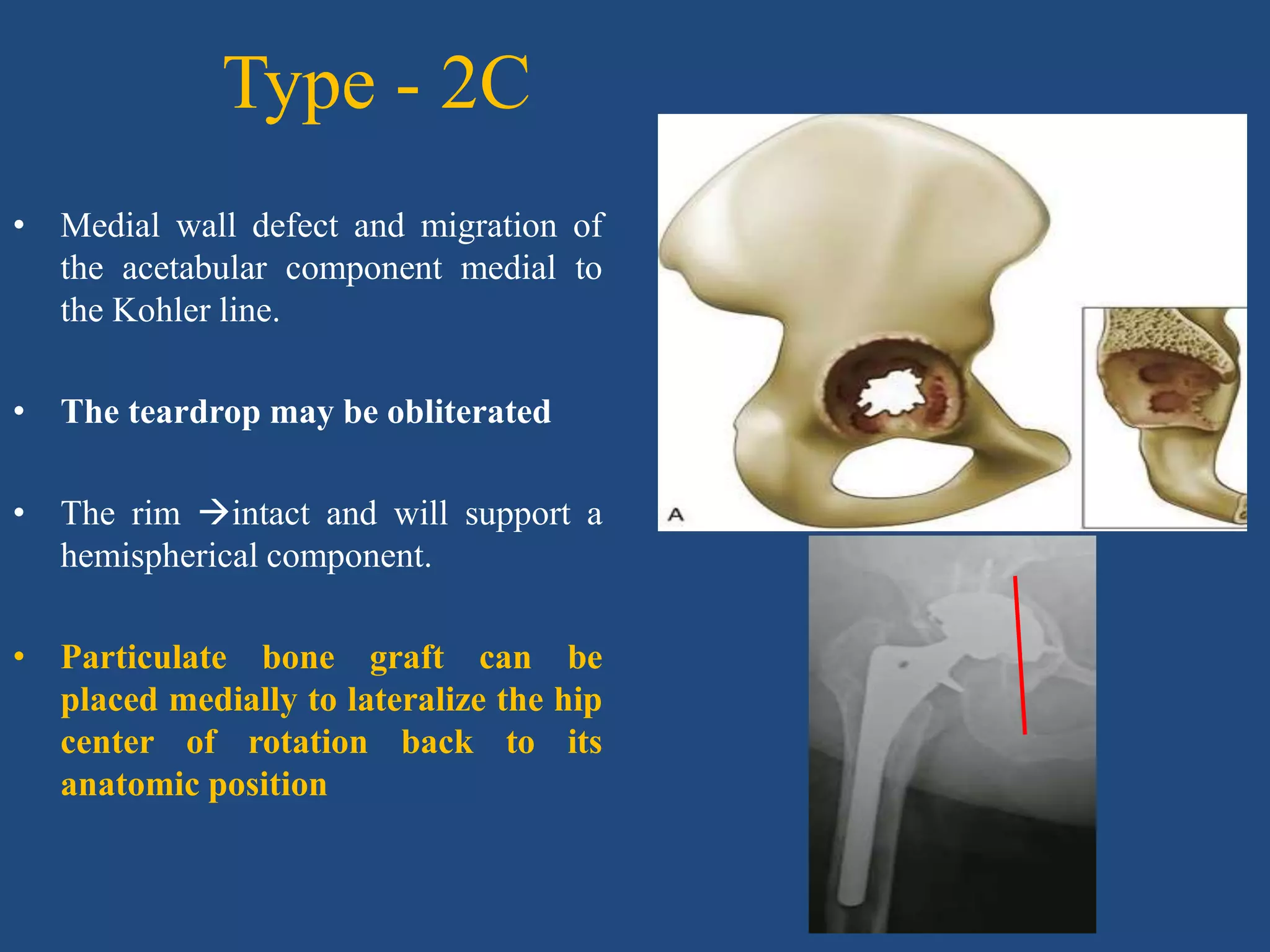 Acetabular defects | PPTX