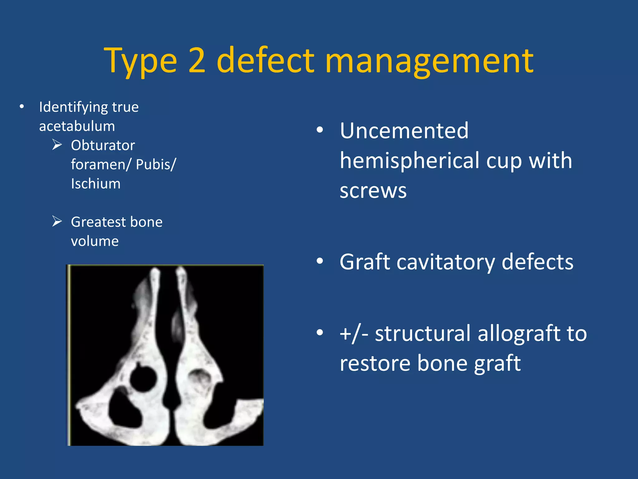 Acetabular defects | PPTX