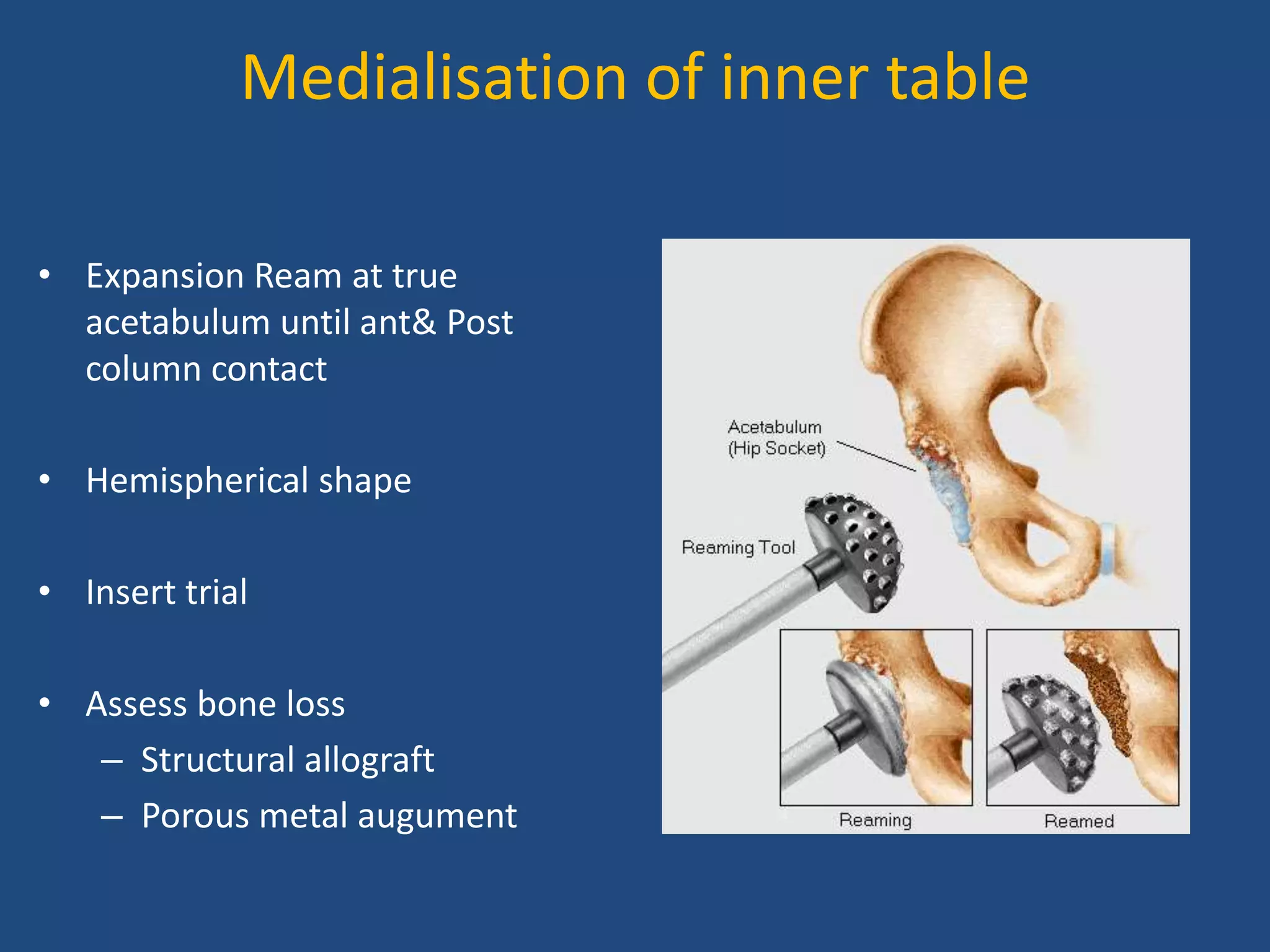 Acetabular defects | PPTX
