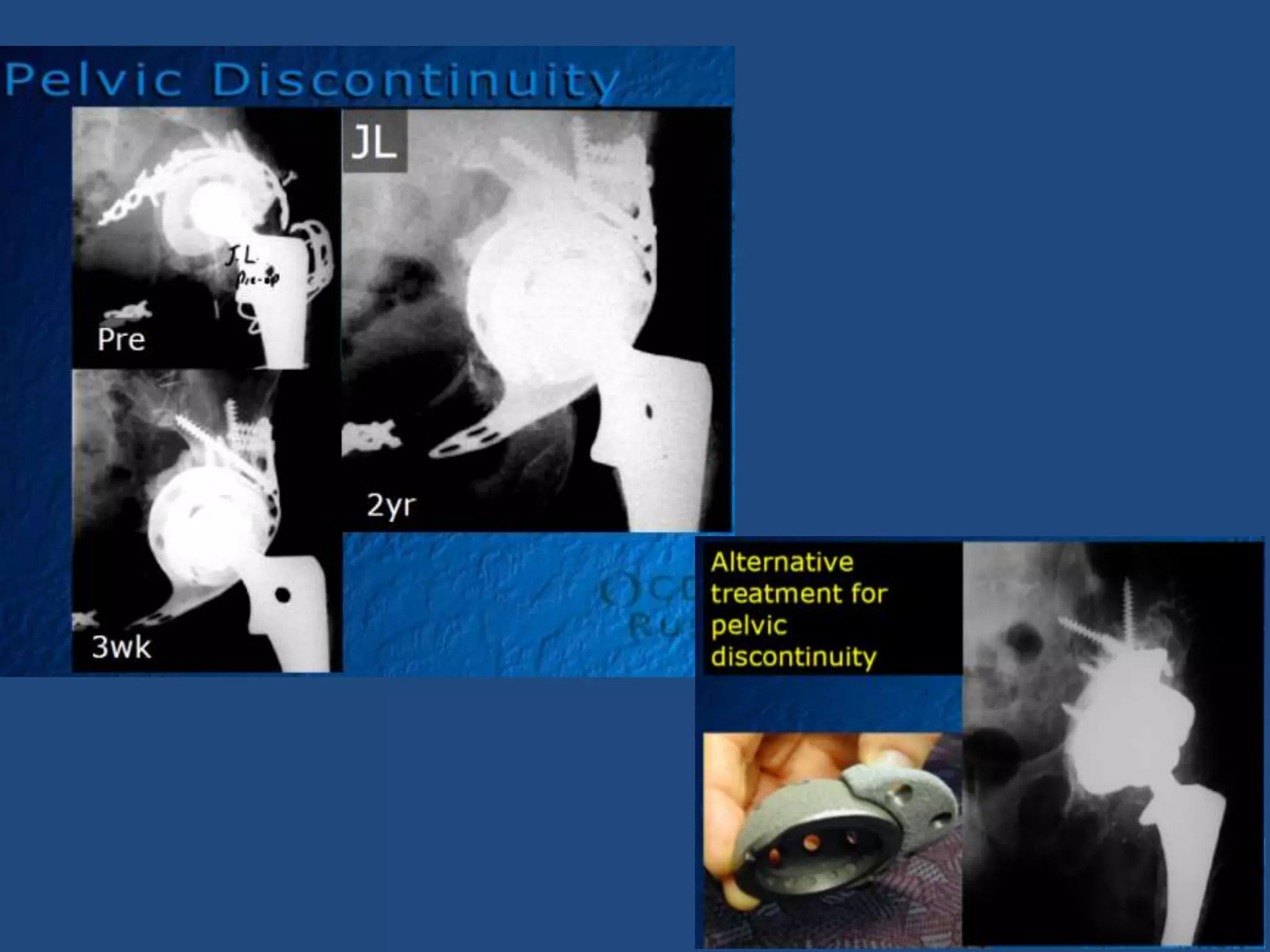 Acetabular defects | PPTX