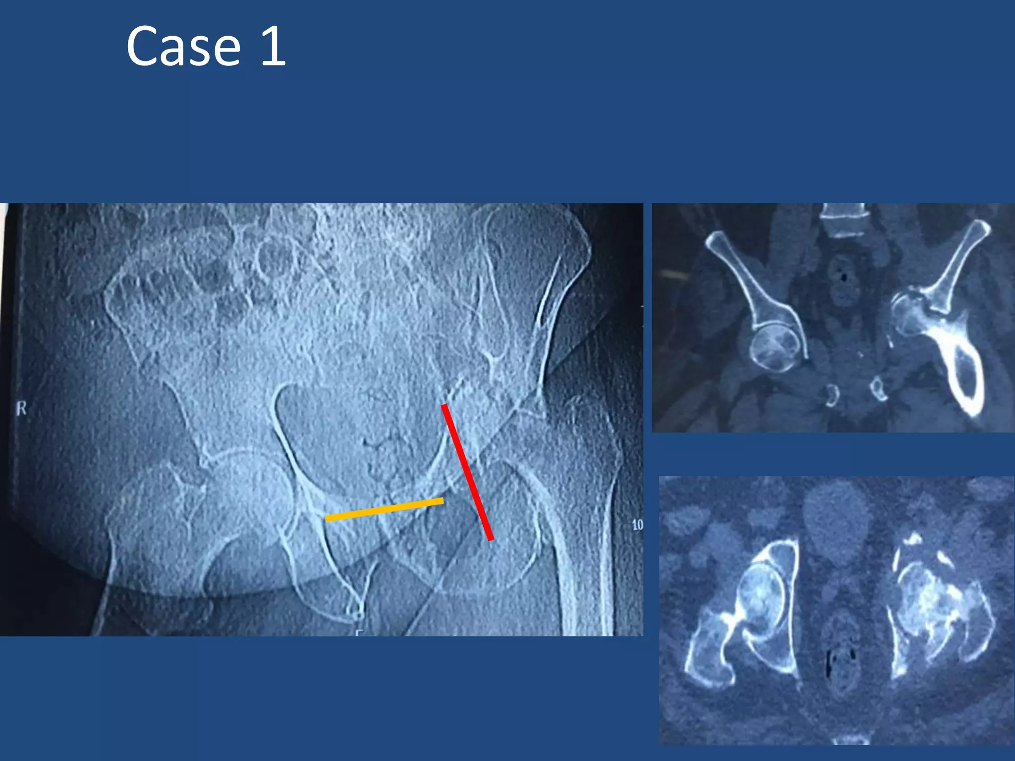 Acetabular defects | PPTX
