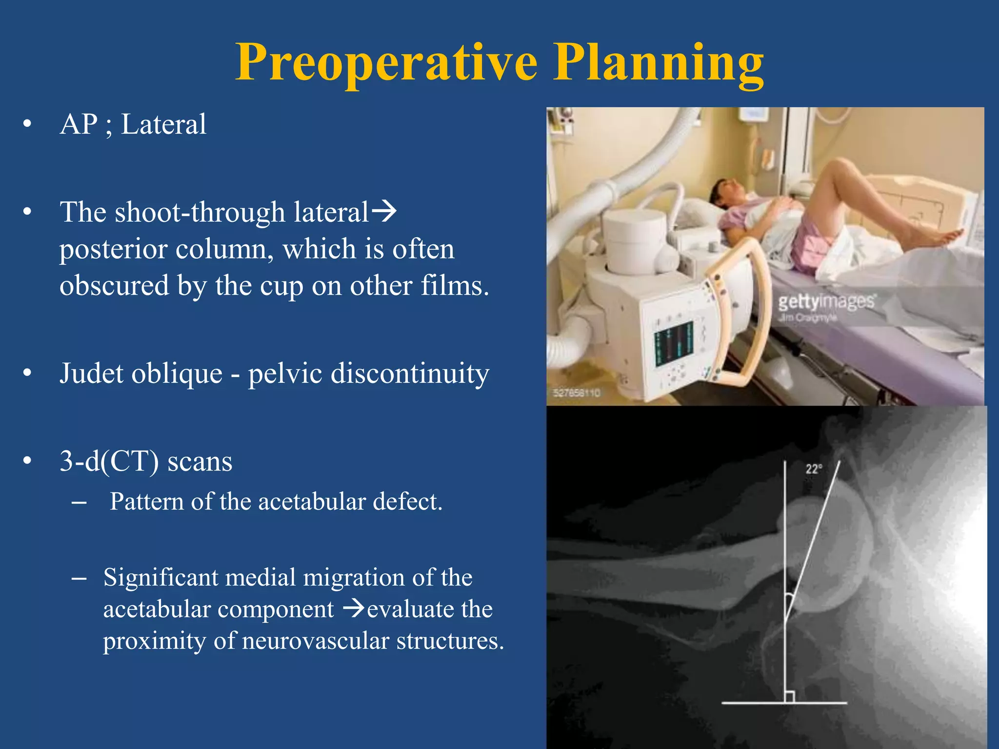 Acetabular defects | PPTX