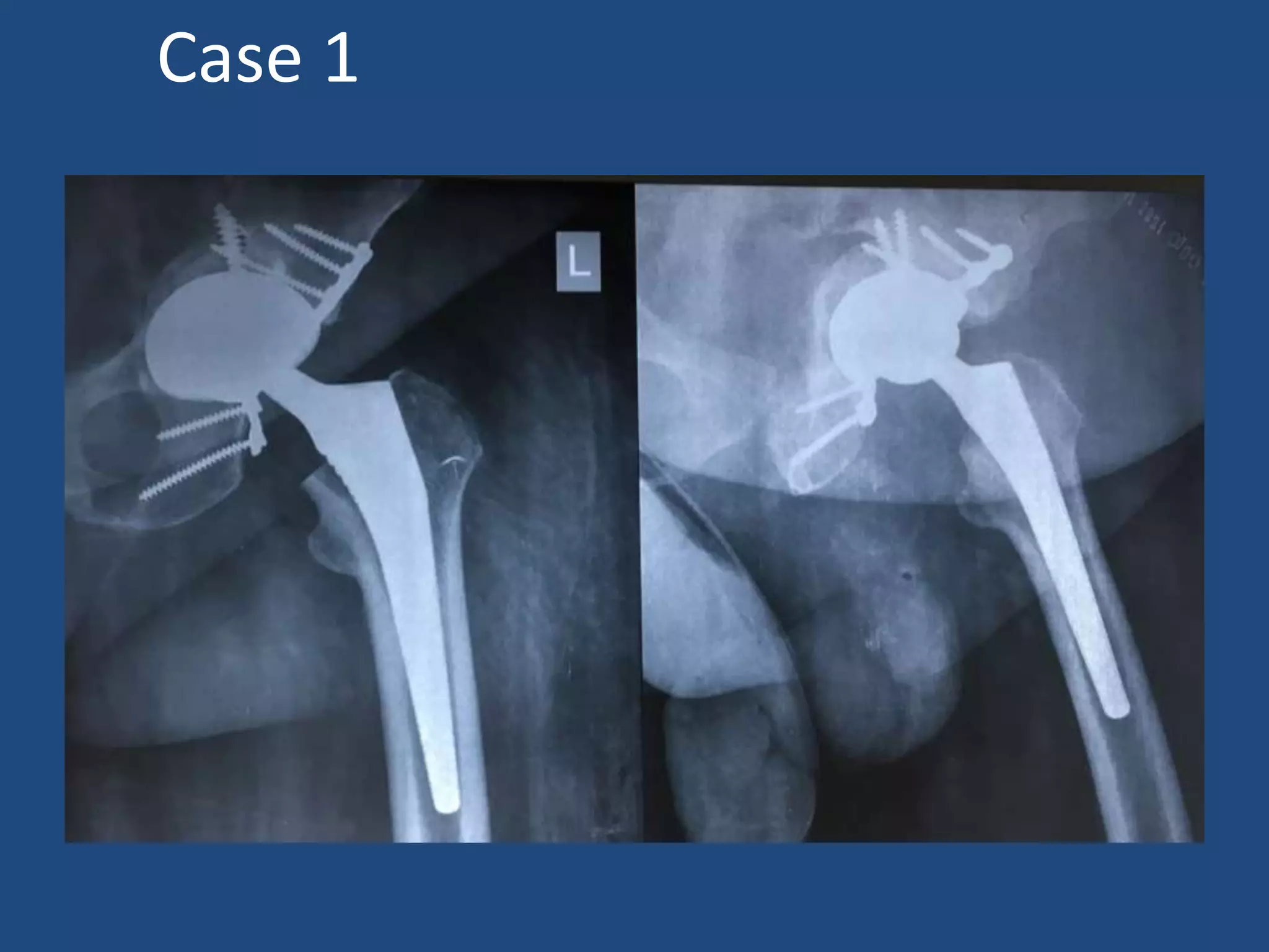 Acetabular defects | PPTX