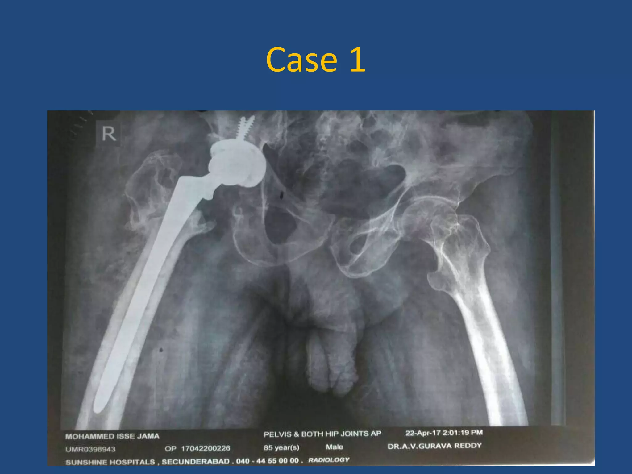 Acetabular defects | PPTX