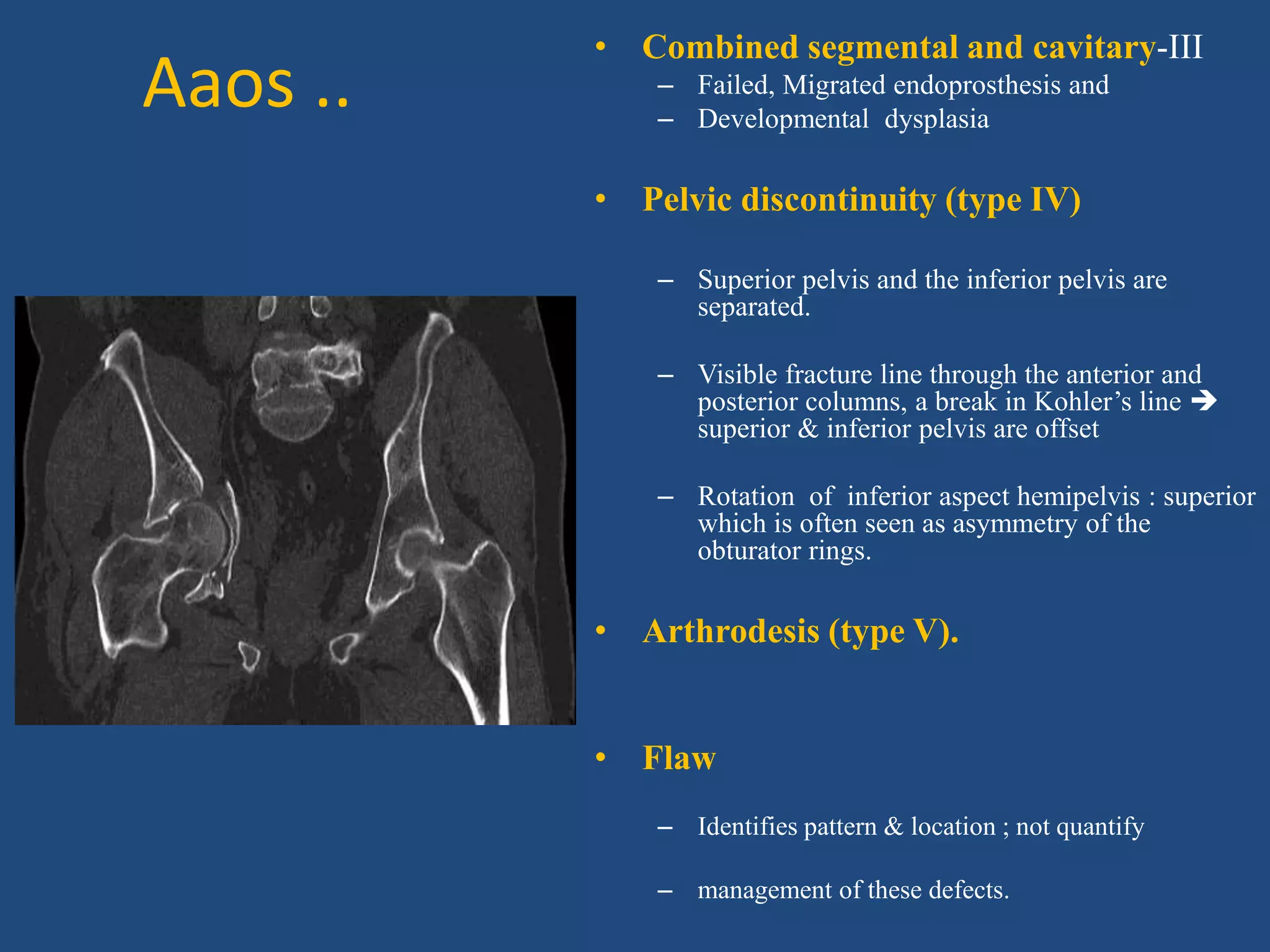 Acetabular defects | PPT