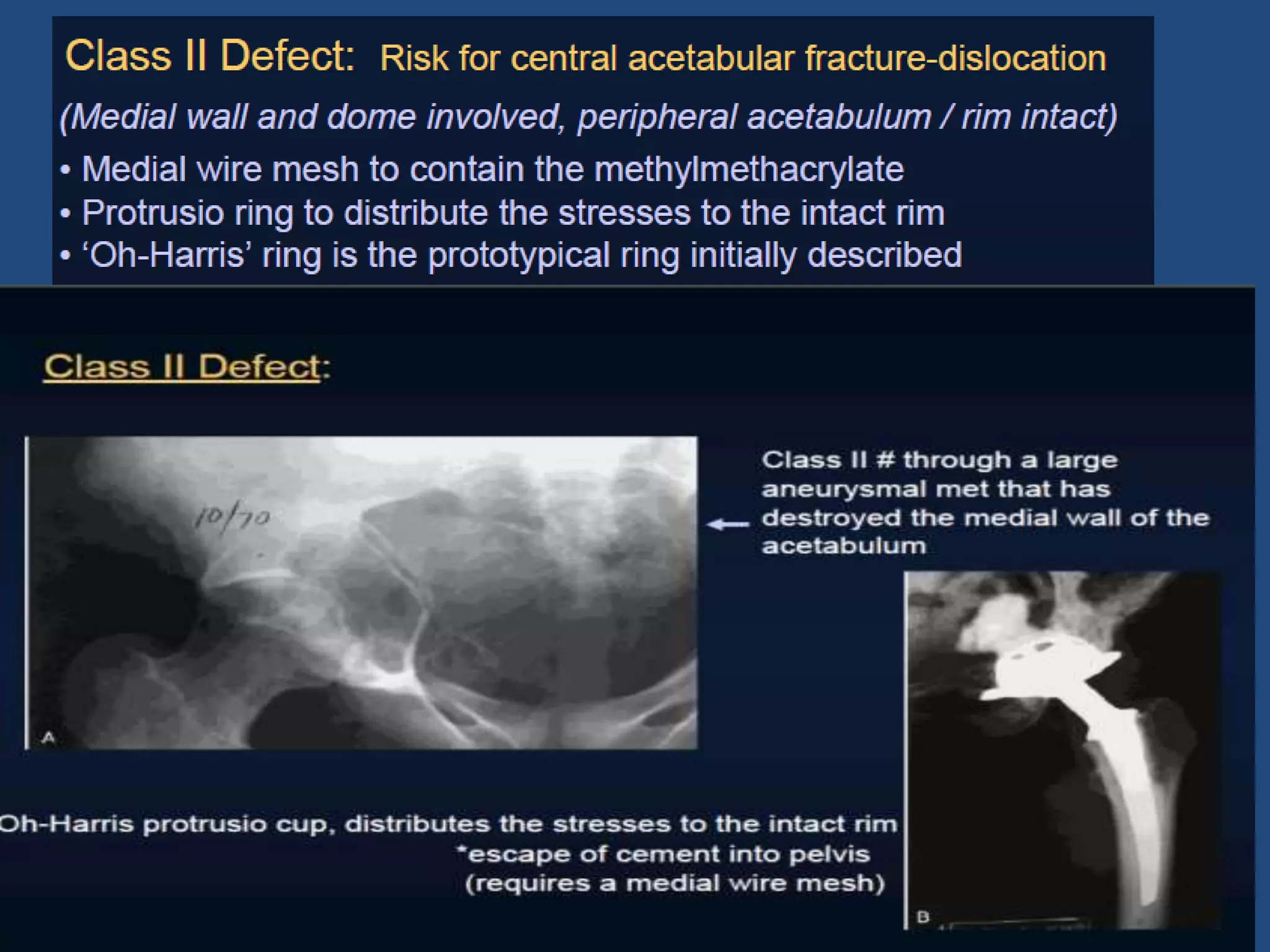 Acetabular defects | PPTX