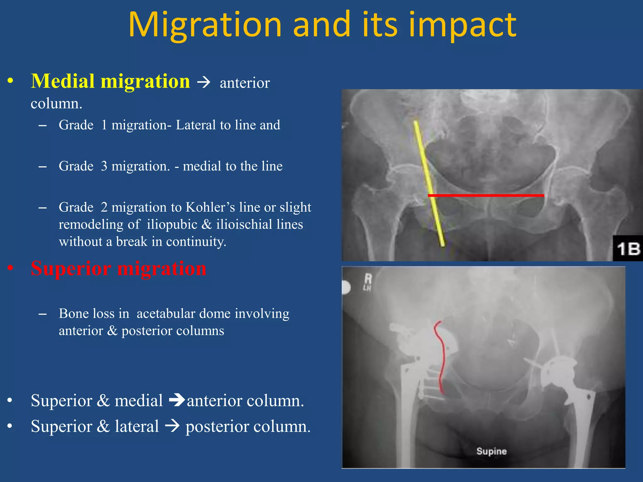 Acetabular defects | PPTX