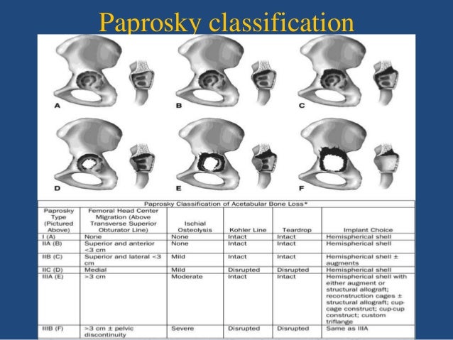 Acetabular defects