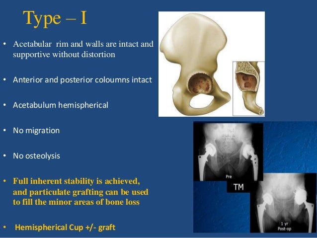 Acetabular defects