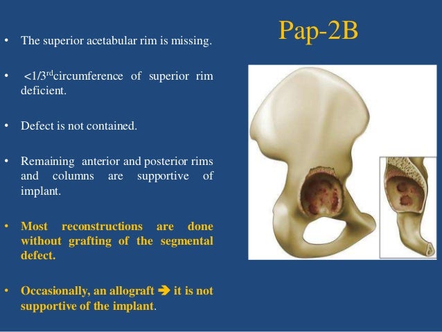 Acetabular defects