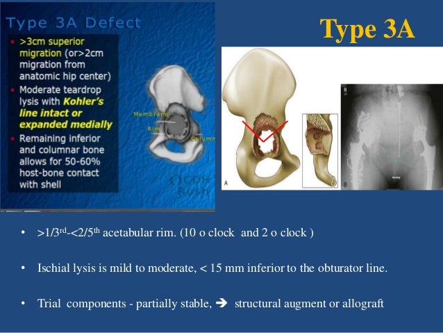 Acetabular defects