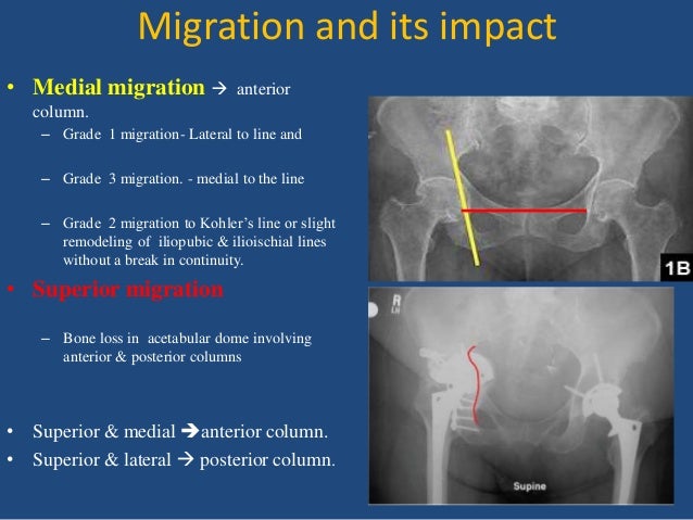 Acetabular defects