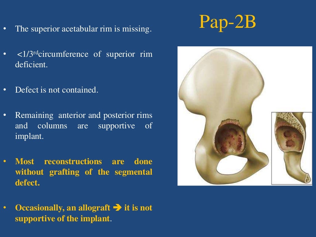 Acetabular defects