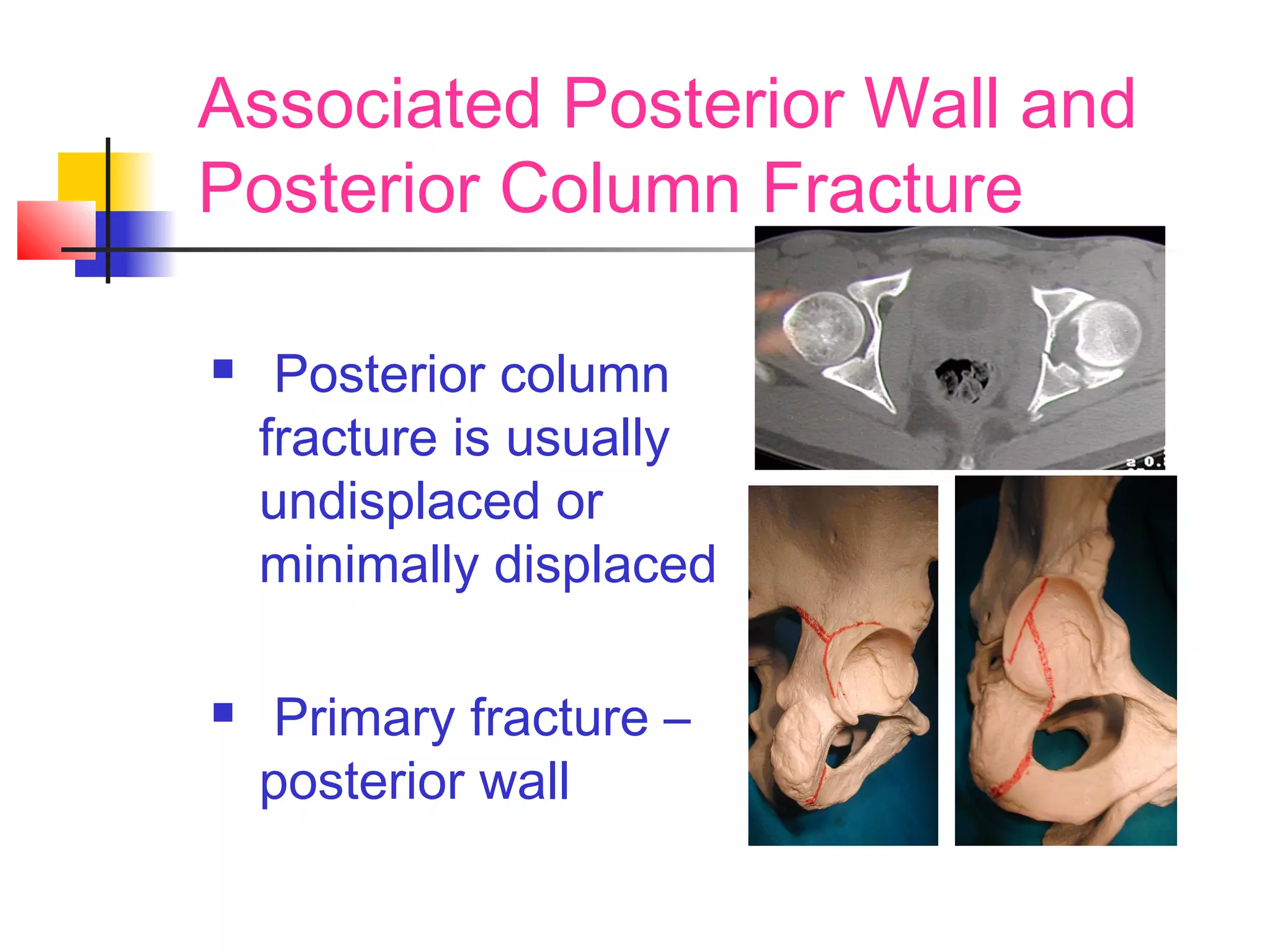 Acetabular fraacture management with surgical approaches | PPT