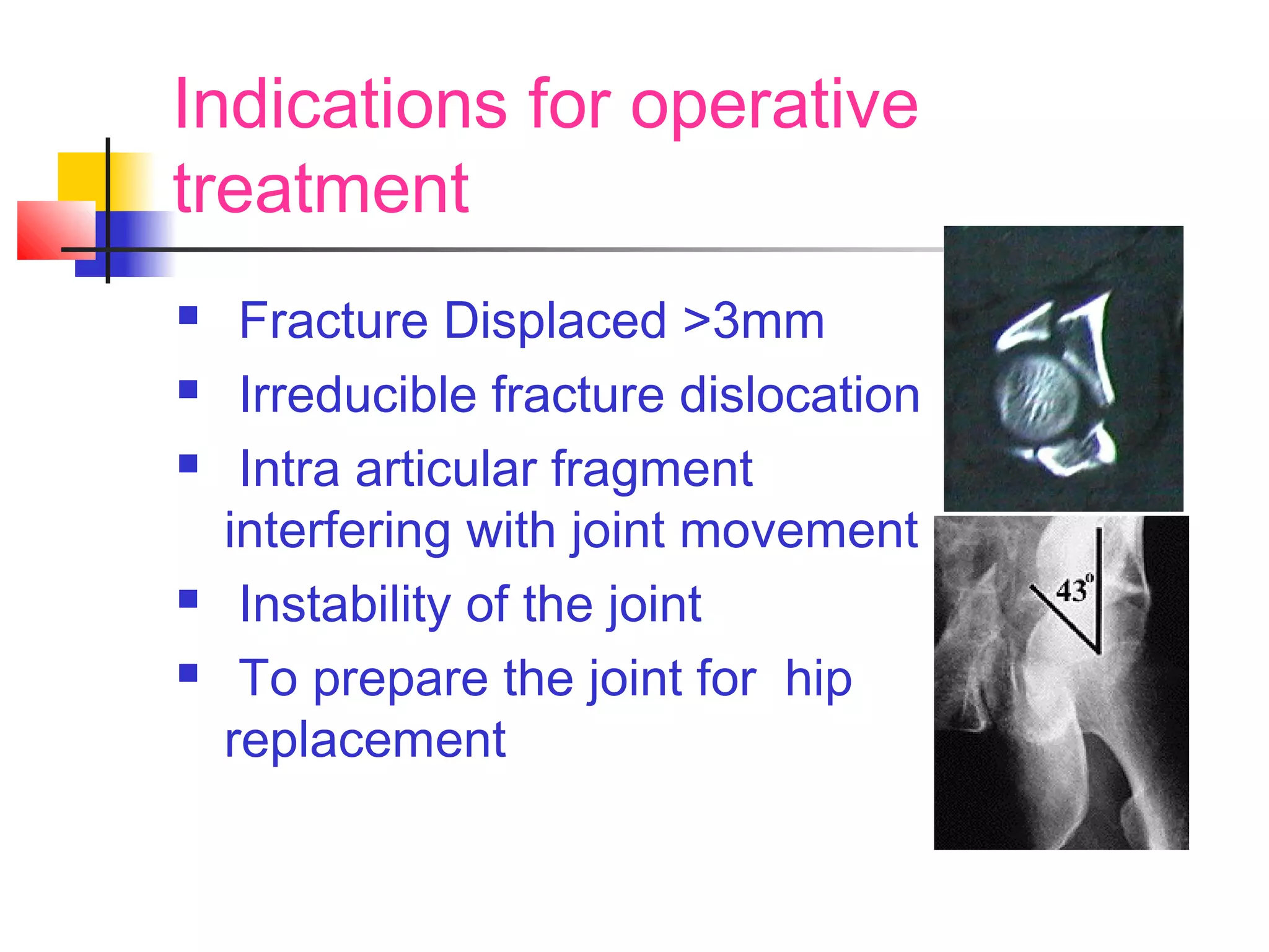 Acetabular fraacture management with surgical approaches | PPT