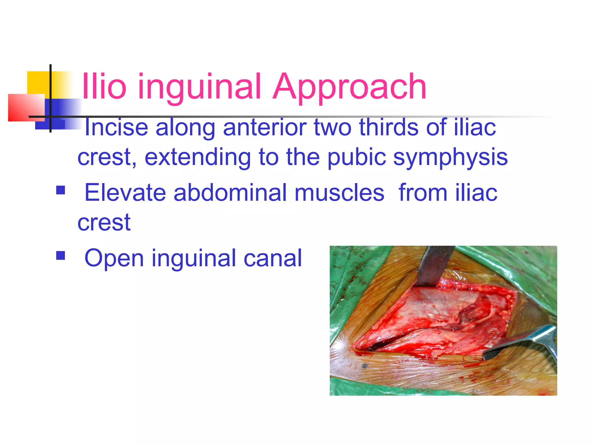 Acetabular fraacture management with surgical approaches | PPT