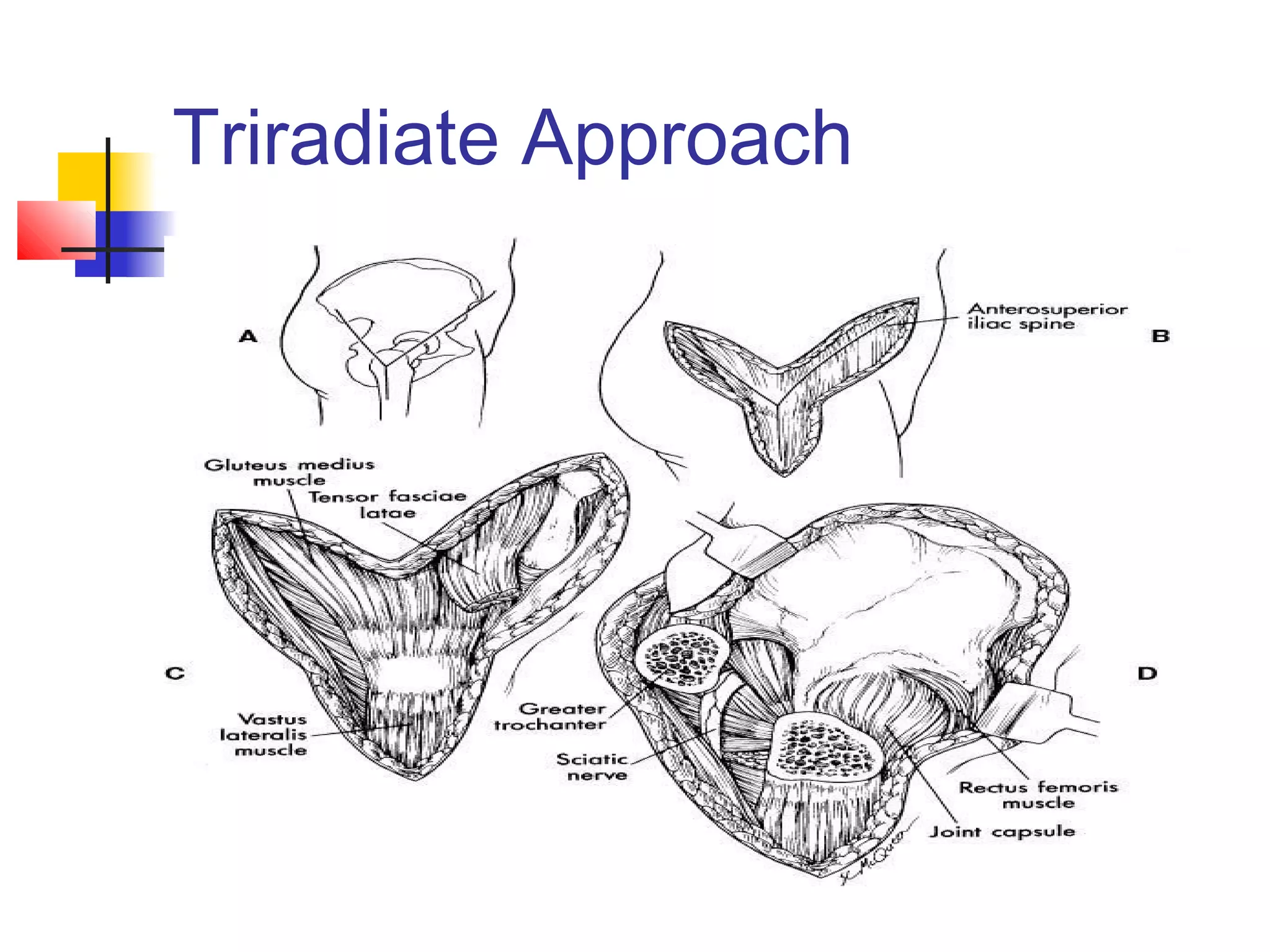 Acetabular fraacture management with surgical approaches | PPT