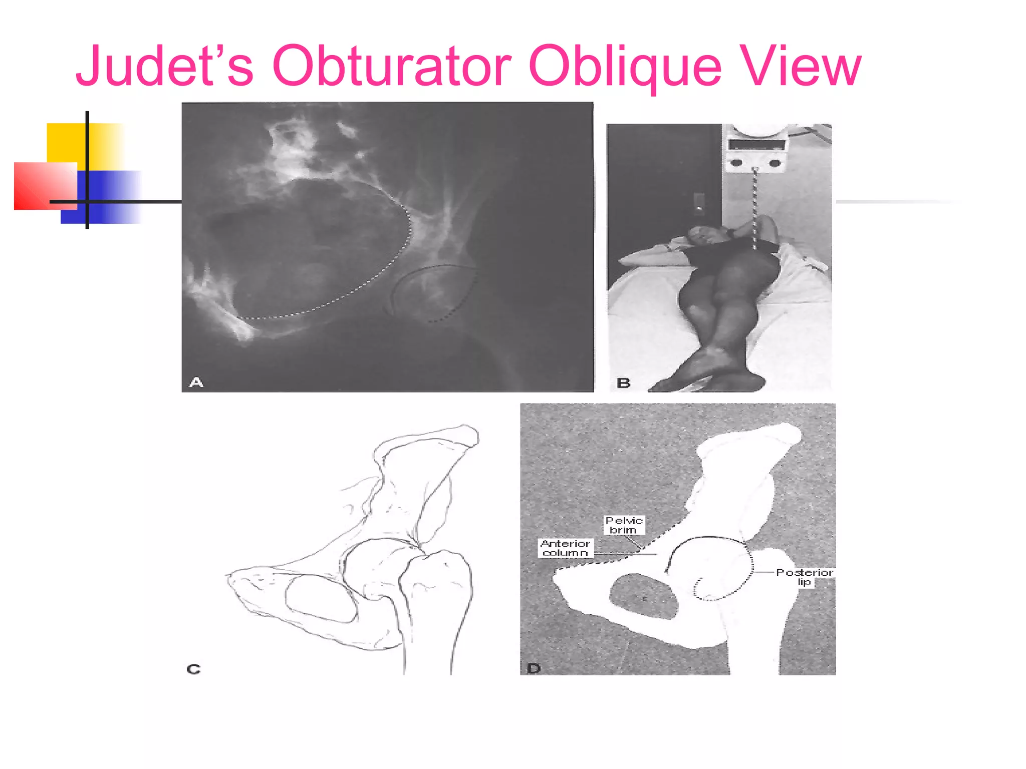Acetabular fraacture management with surgical approaches | PPT