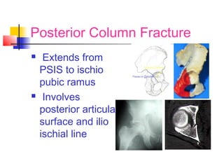 Acetabular fraacture management with surgical approaches | PPT