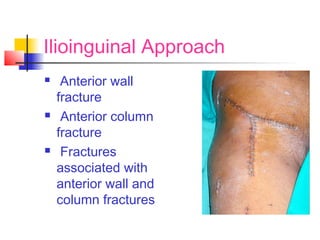 Acetabular fraacture management with surgical approaches | PPT