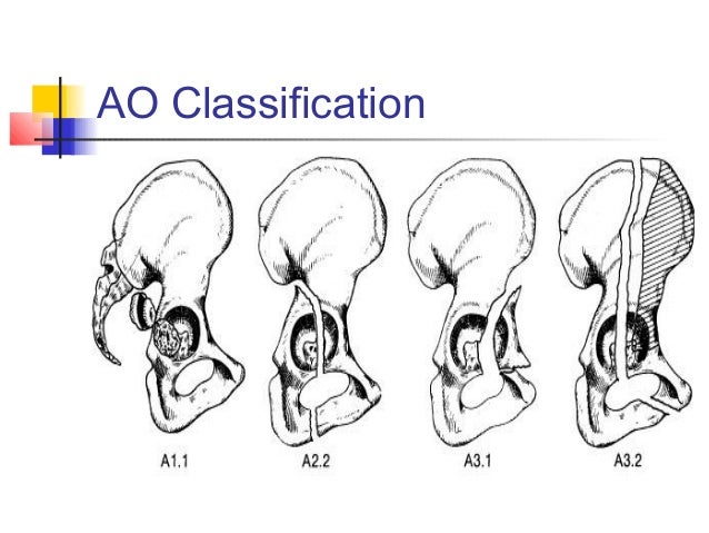 Acetabular fraacture management with surgical approaches